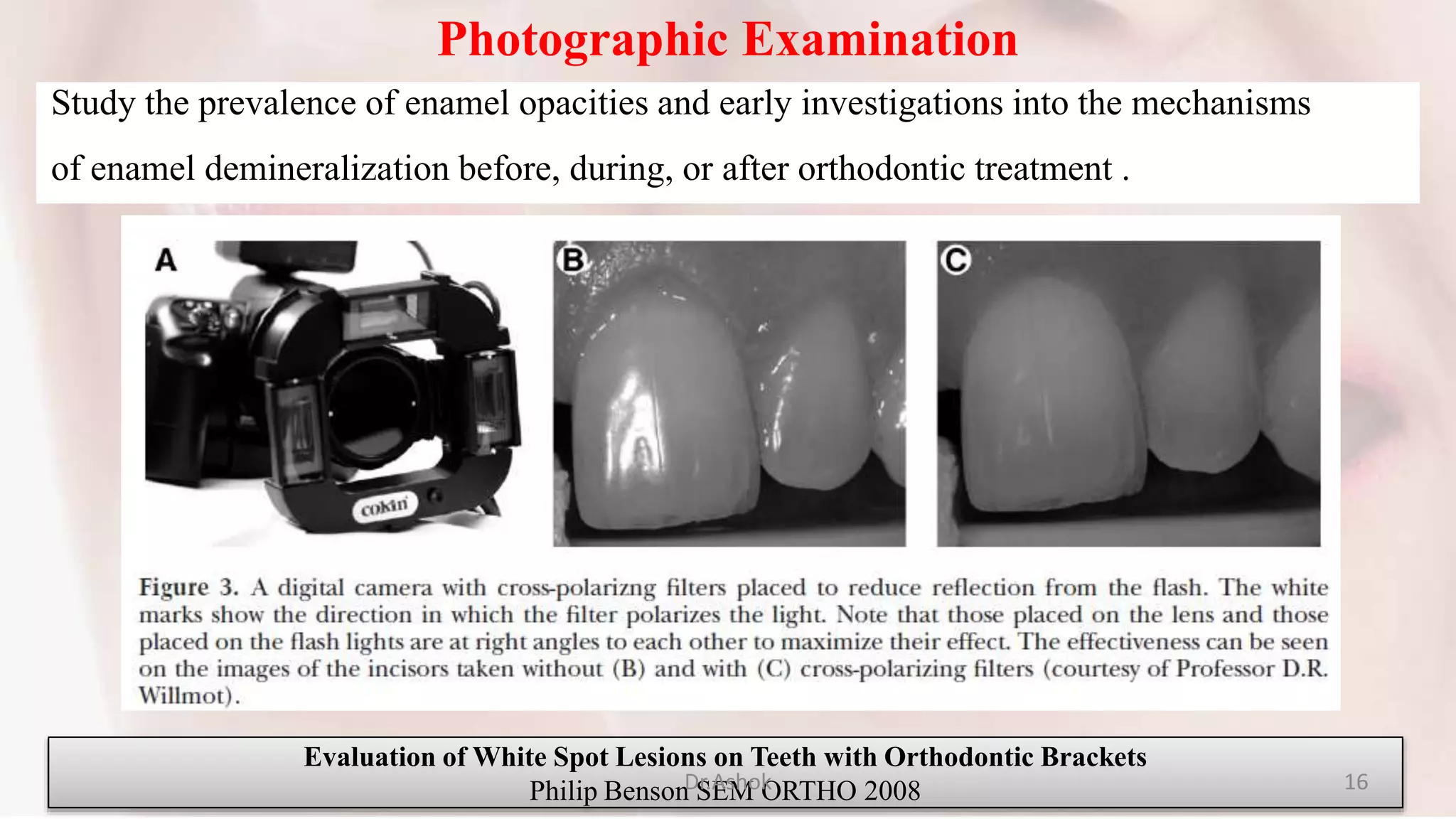 white spot lesion - prevention and management | PPTX