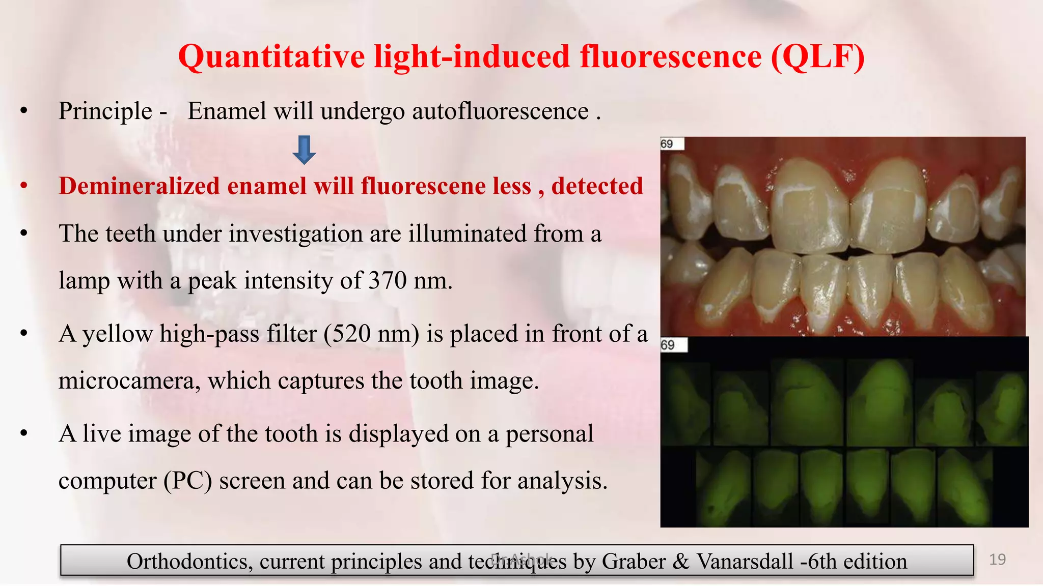 white spot lesion - prevention and management | PPTX