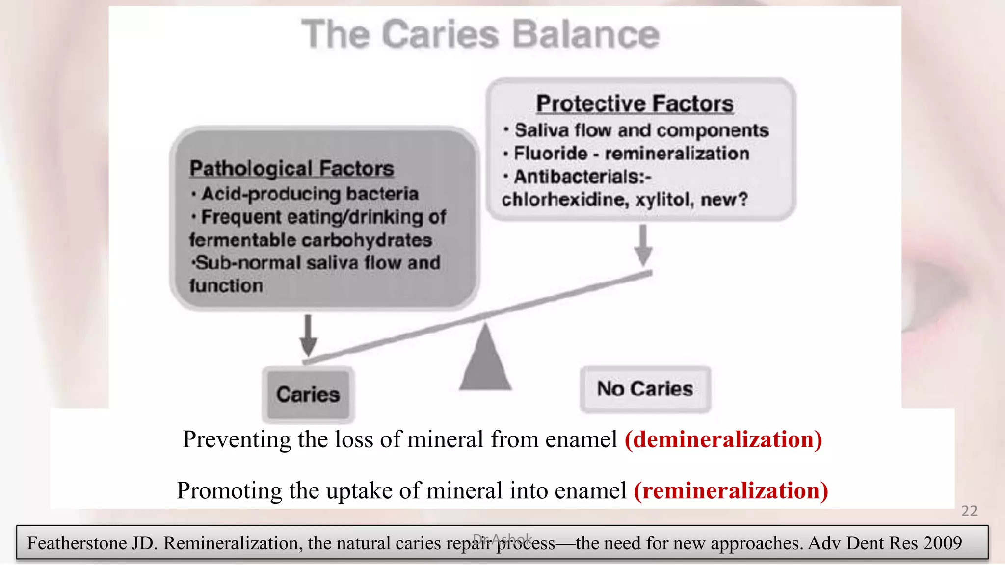 white spot lesion - prevention and management | PPTX