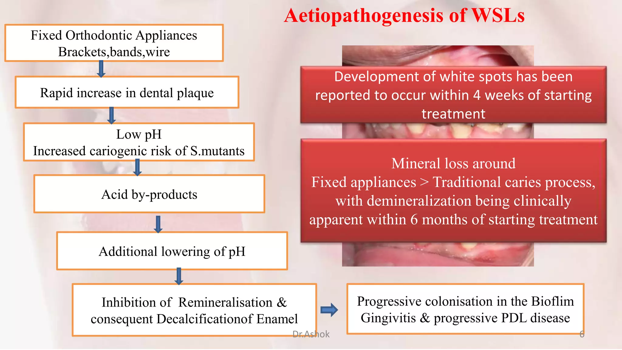 white spot lesion - prevention and management | PPTX