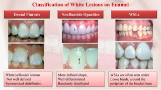 white spot lesion - prevention and management | PPTX