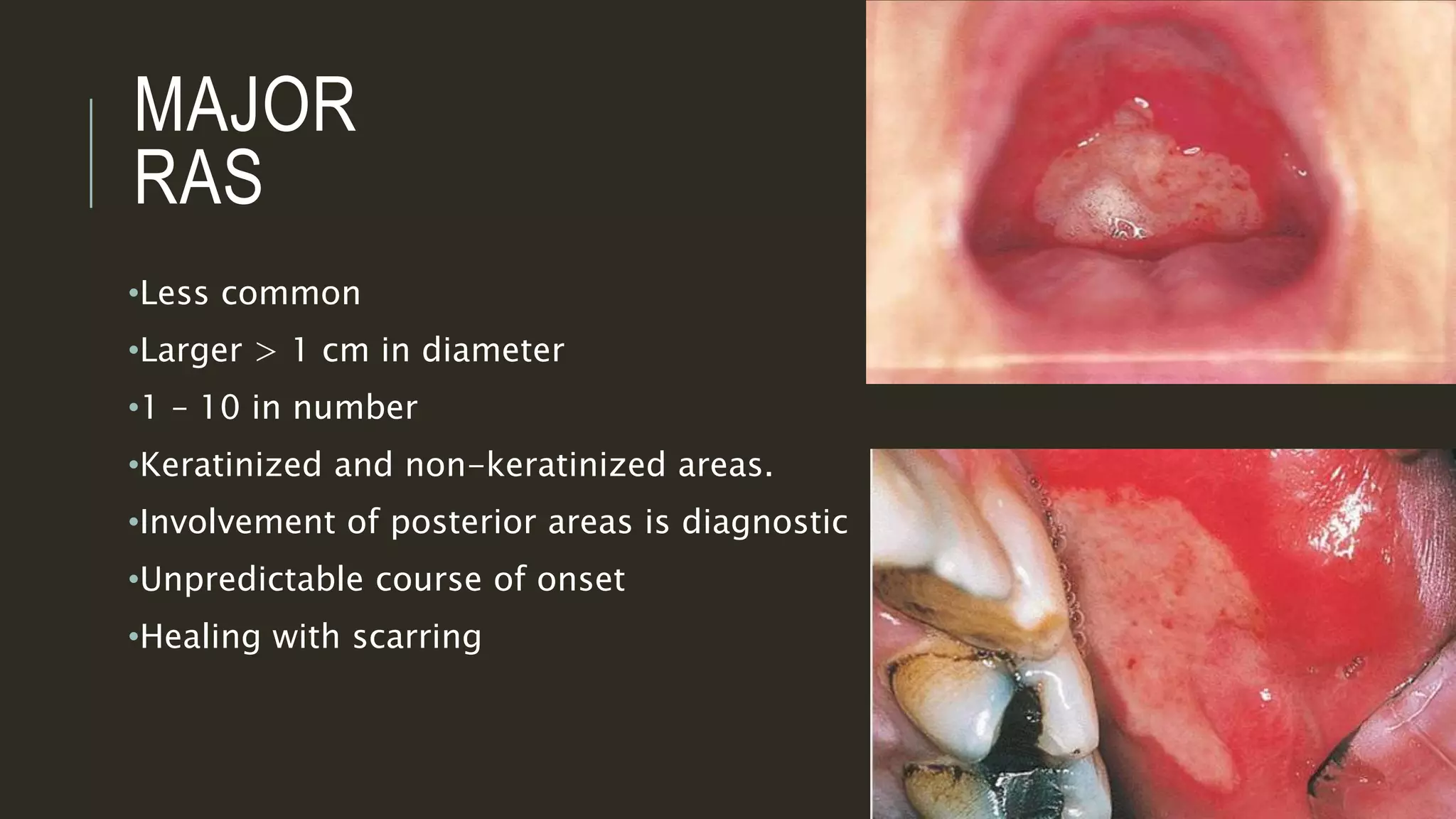 Oral Ulceration | PPTX