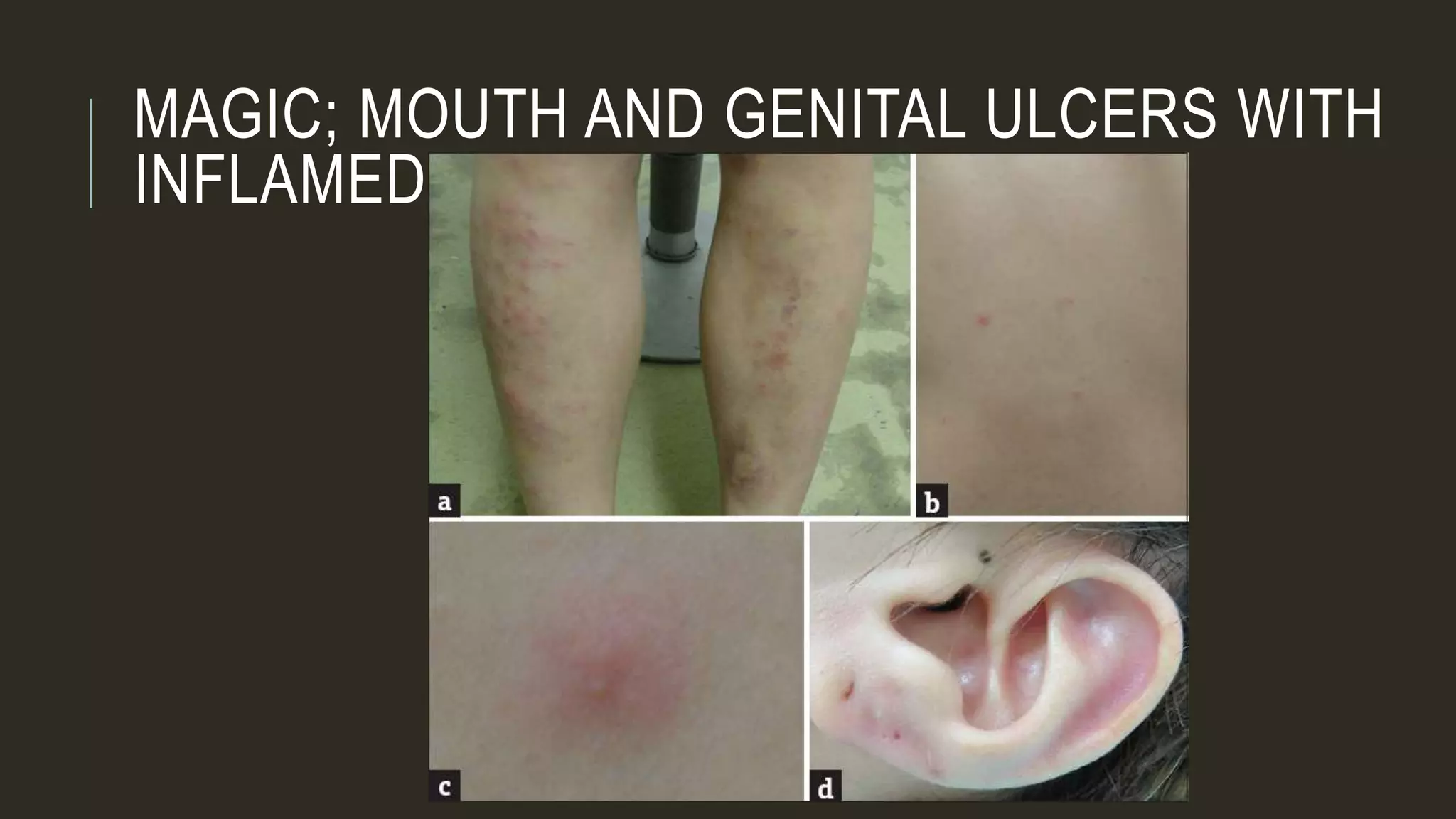 Oral Ulceration | PPTX