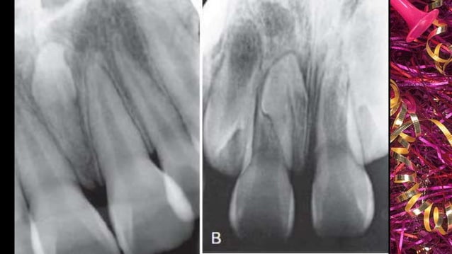 Radiographic Interpretation of Dental Anomalies | PPTX | Dental Health ...