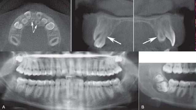 Radiographic Interpretation of Dental Anomalies | PPTX | Dental Health ...