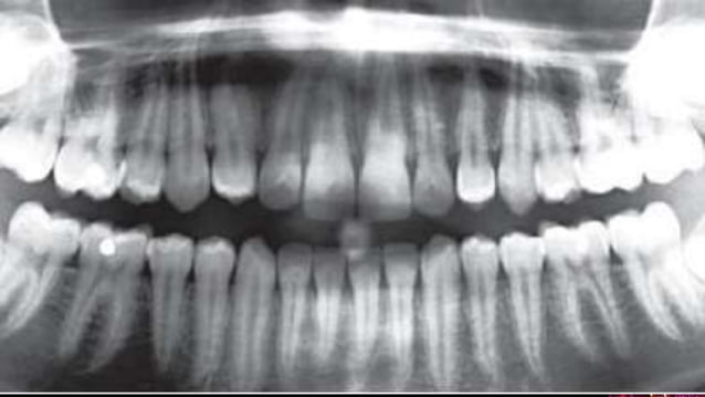 Radiographic Interpretation of Dental Anomalies | PPTX | Dental Health ...