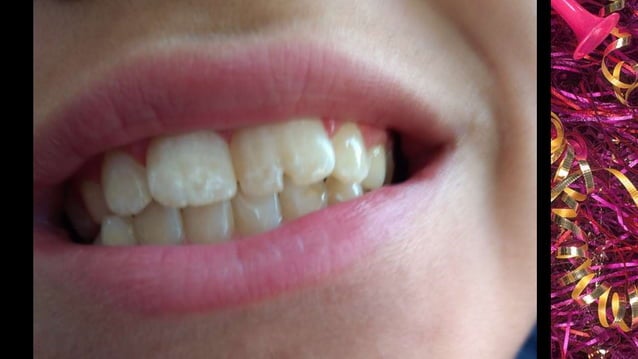 Radiographic Interpretation of Dental Anomalies | PPTX | Dental Health ...