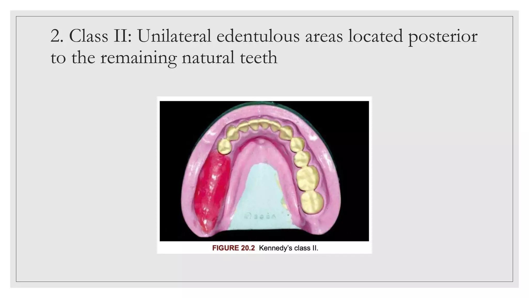 classification of partially edentulous arches | PPTX