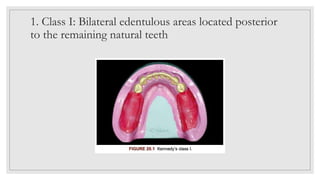 classification of partially edentulous arches | PPTX