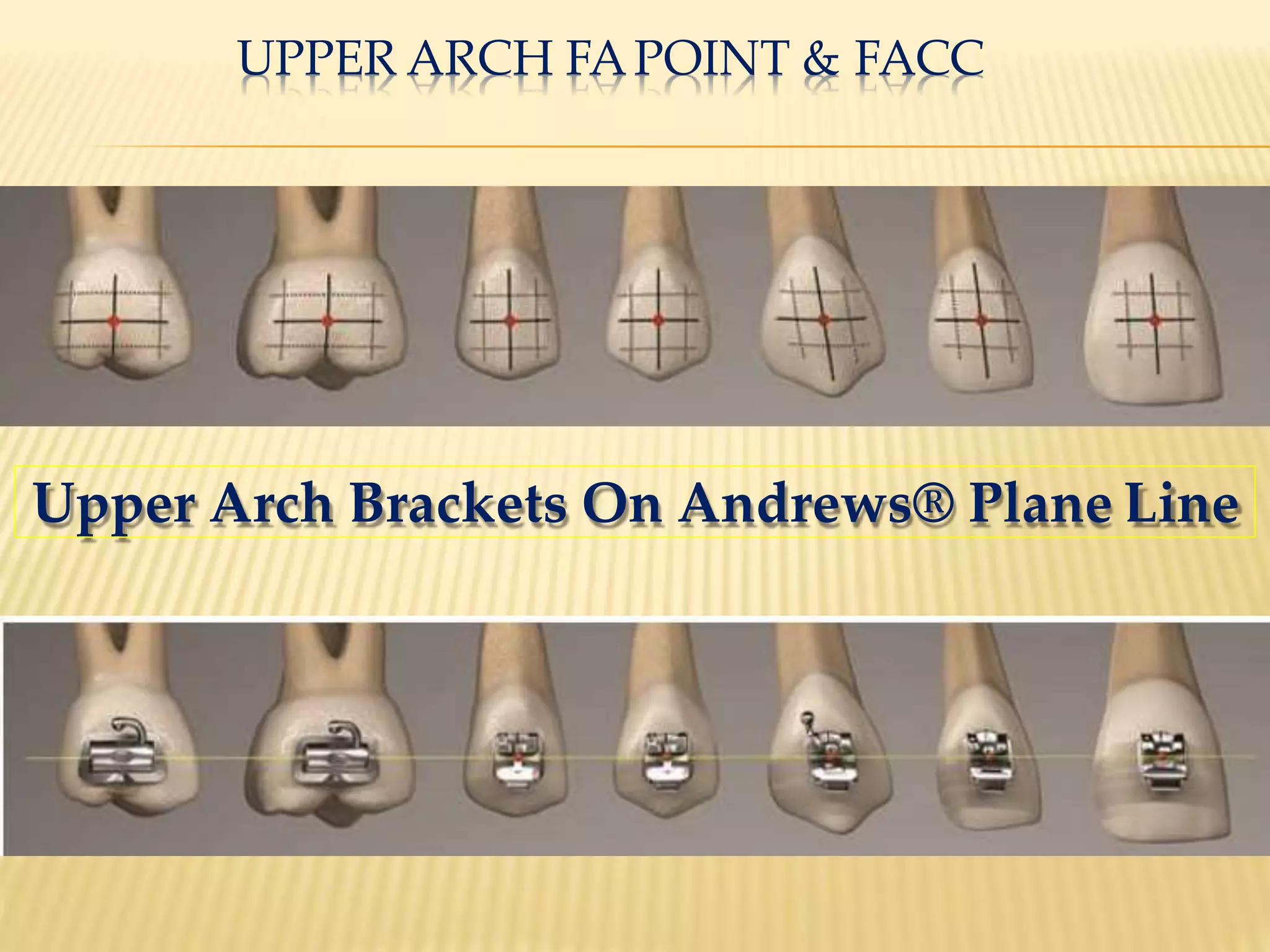 BRACKET PLACEMENT IN ORTHODONTIC BONDING | PPTX