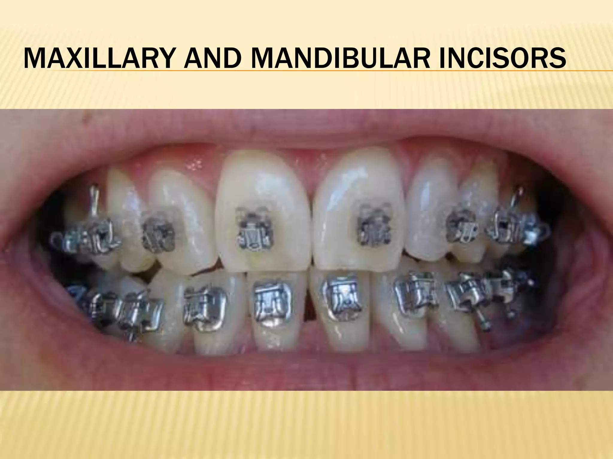 BRACKET PLACEMENT IN ORTHODONTIC BONDING | PPTX