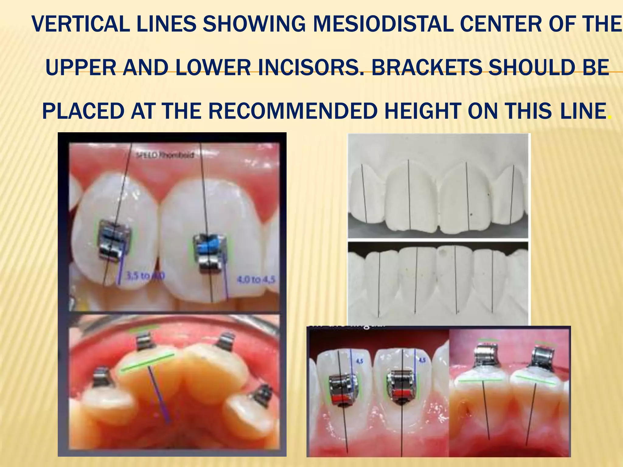 BRACKET PLACEMENT IN ORTHODONTIC BONDING | PPTX