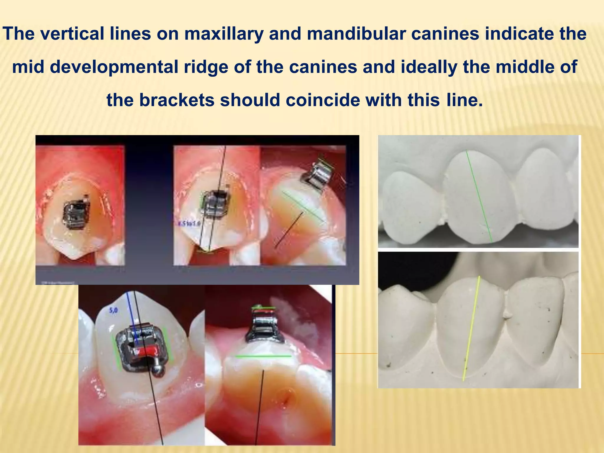 BRACKET PLACEMENT IN ORTHODONTIC BONDING | PPTX