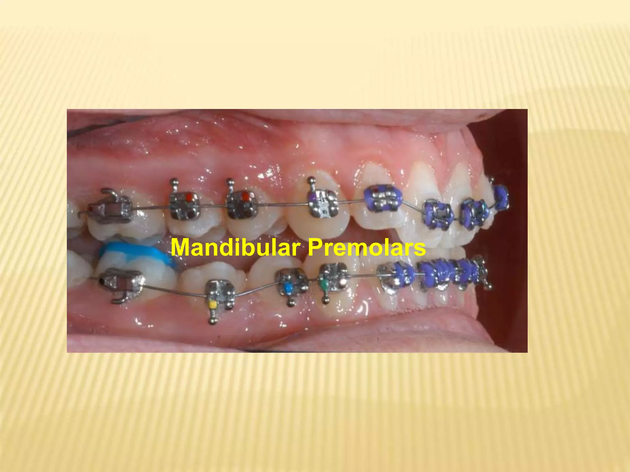 BRACKET PLACEMENT IN ORTHODONTIC BONDING | PPTX