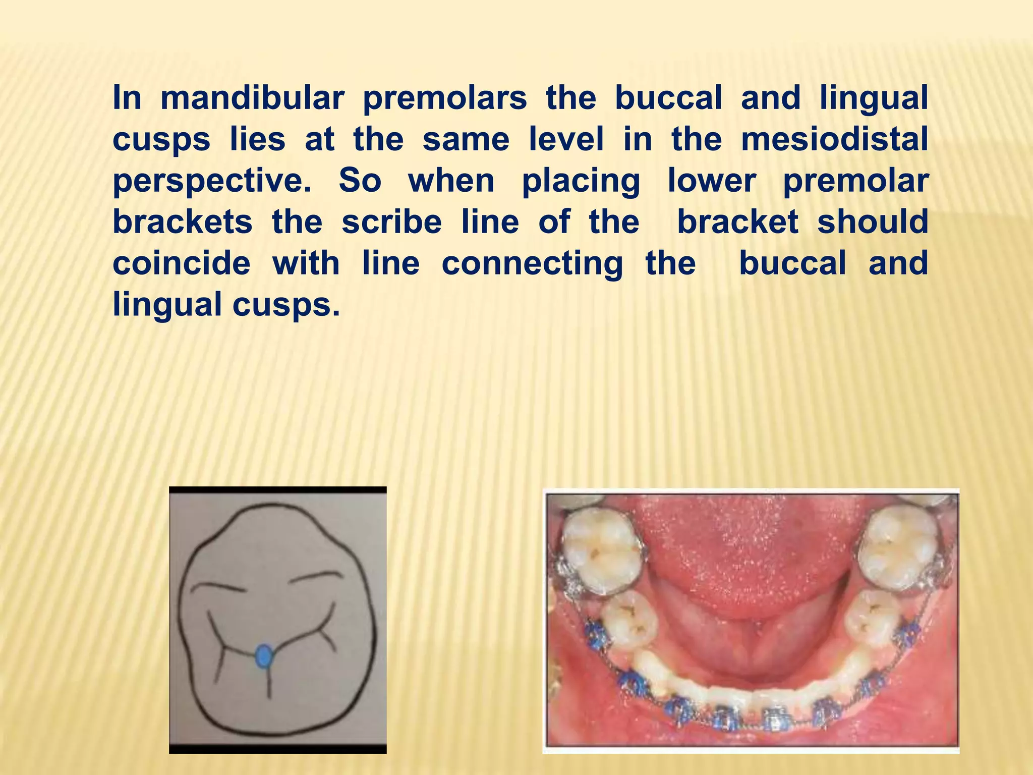 BRACKET PLACEMENT IN ORTHODONTIC BONDING | PPTX
