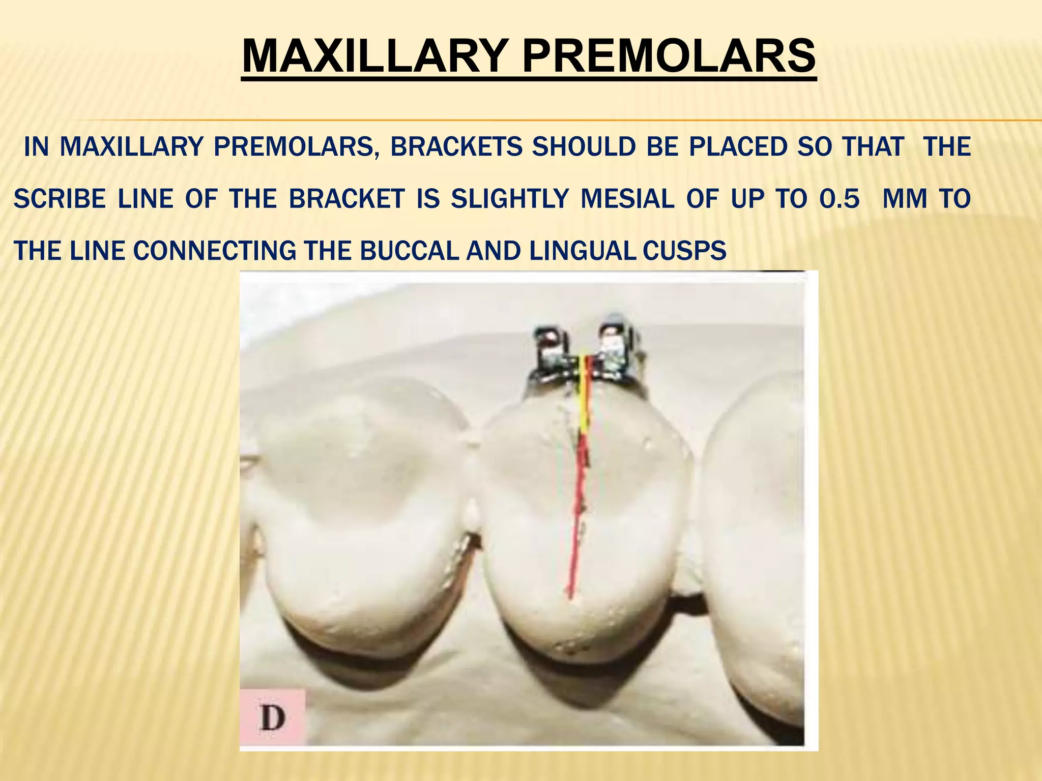 BRACKET PLACEMENT IN ORTHODONTIC BONDING | PPTX