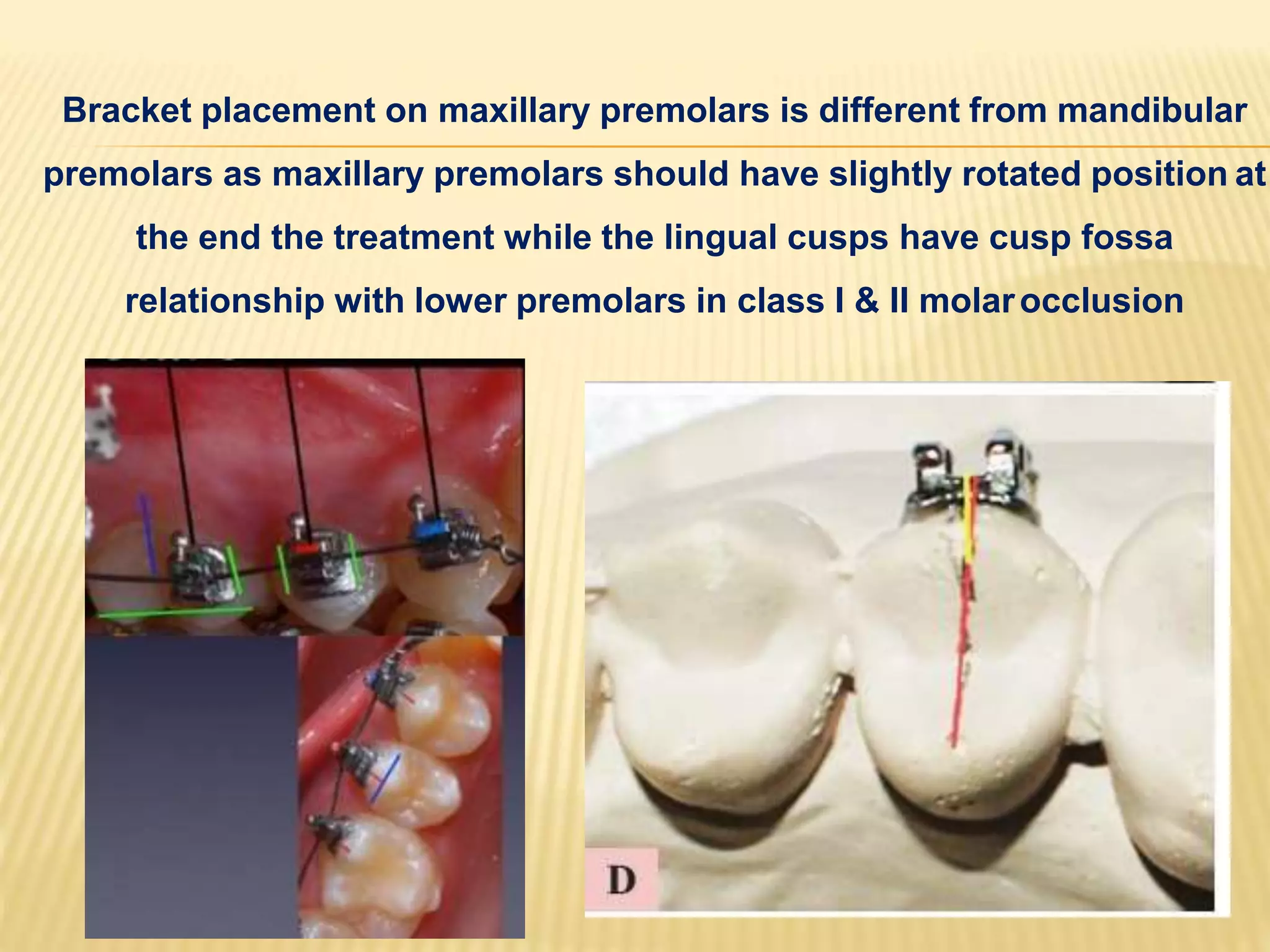BRACKET PLACEMENT IN ORTHODONTIC BONDING | PPTX