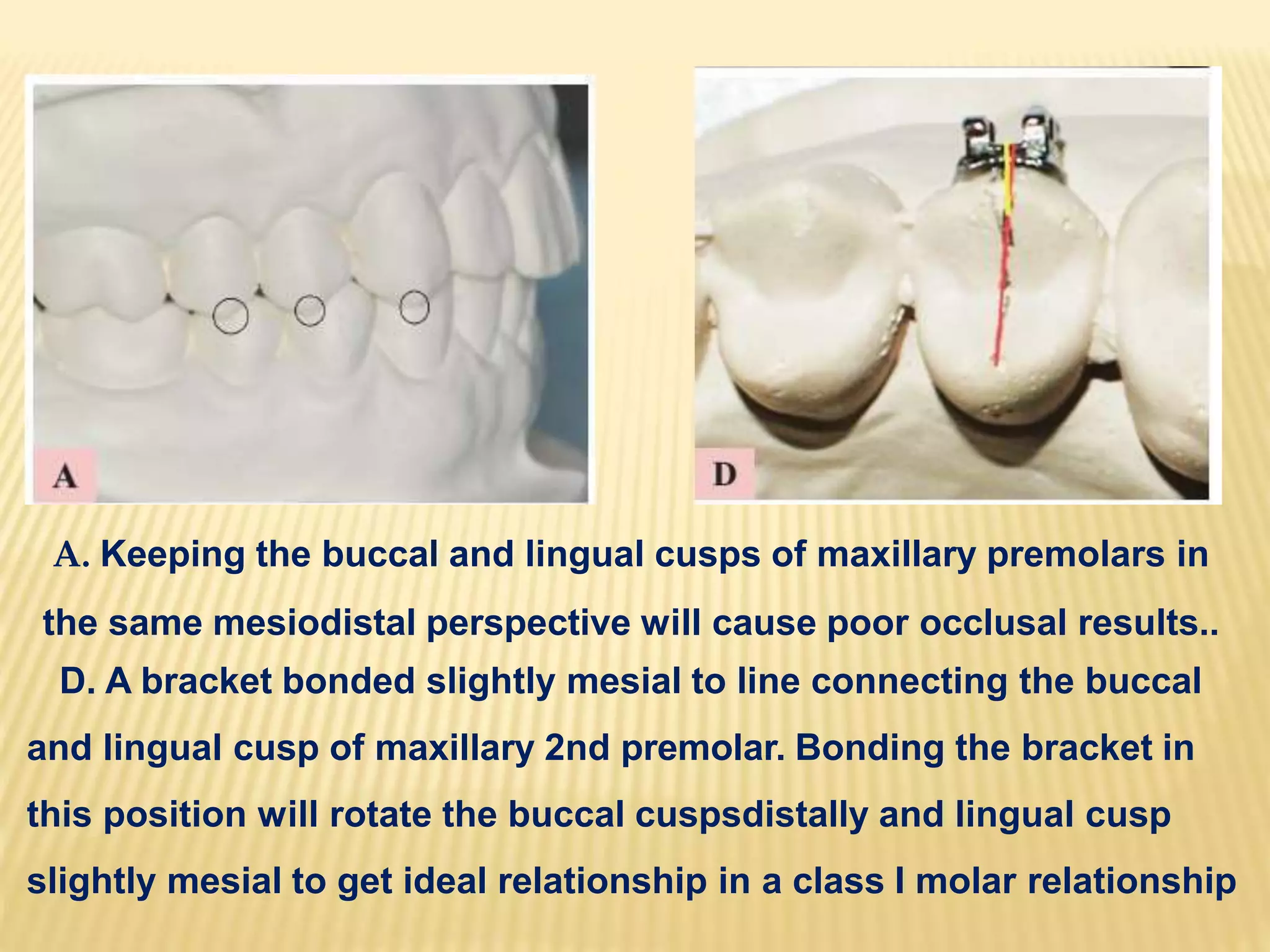 BRACKET PLACEMENT IN ORTHODONTIC BONDING | PPTX