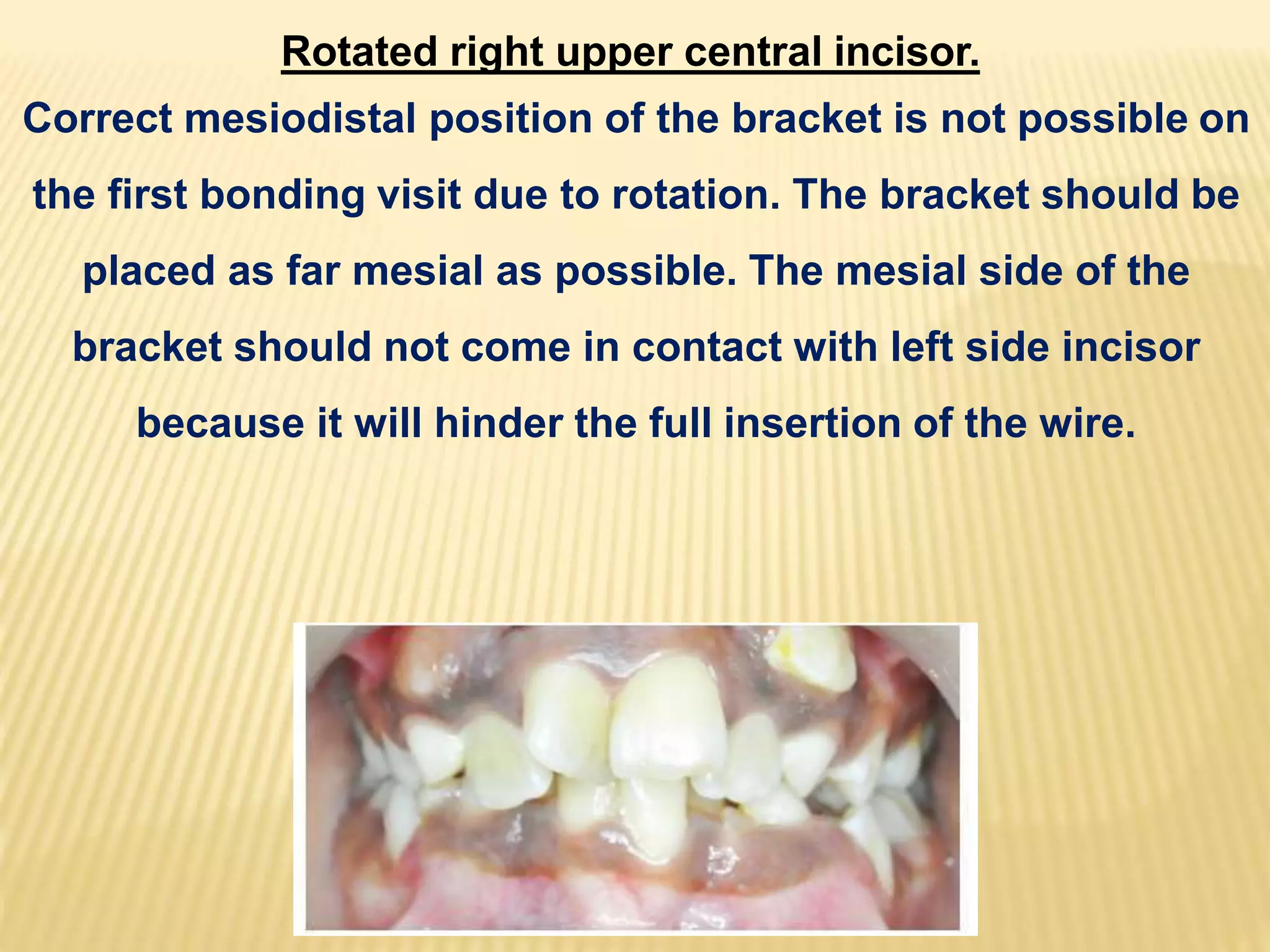 BRACKET PLACEMENT IN ORTHODONTIC BONDING | PPTX