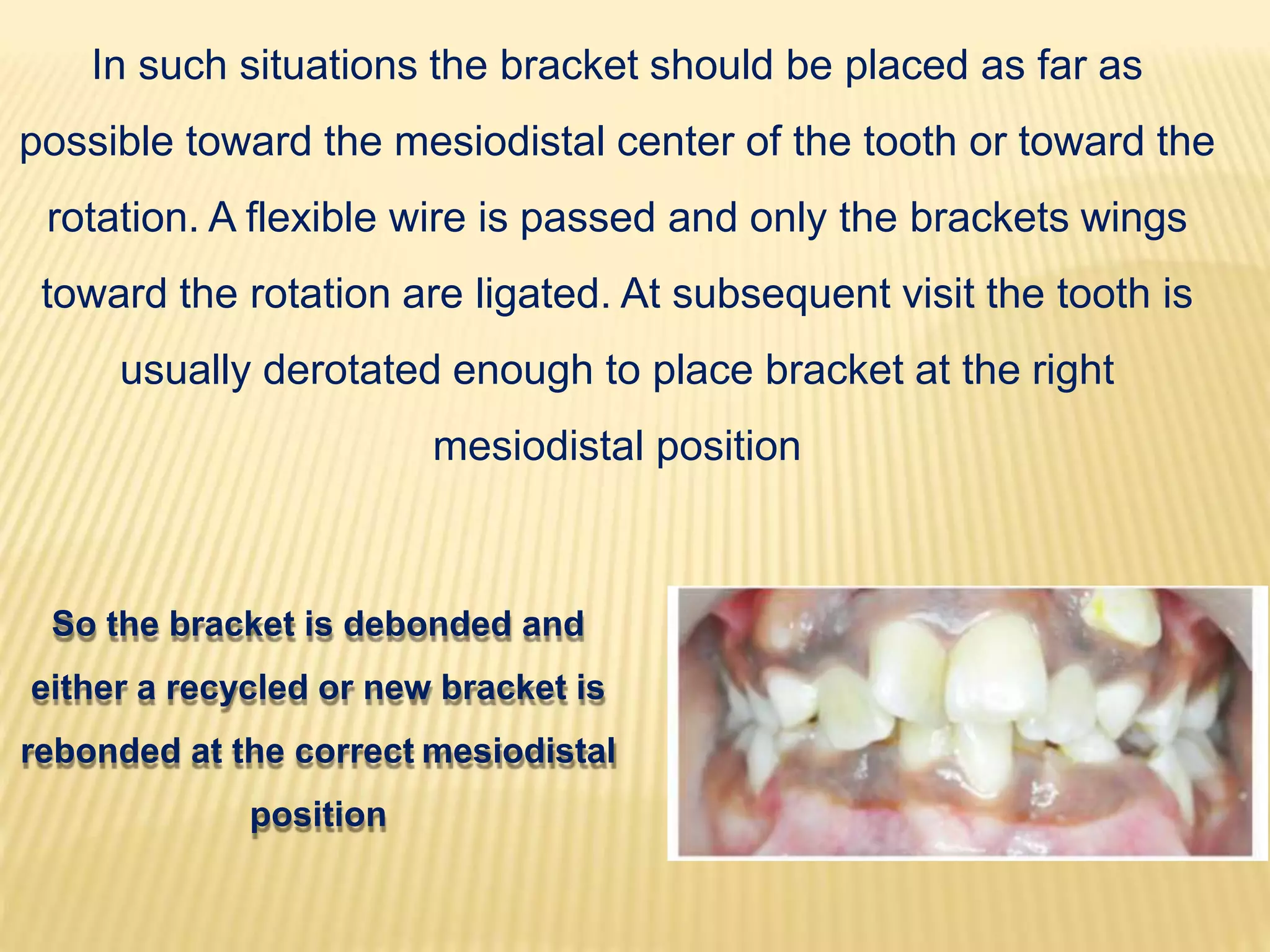 BRACKET PLACEMENT IN ORTHODONTIC BONDING | PPTX