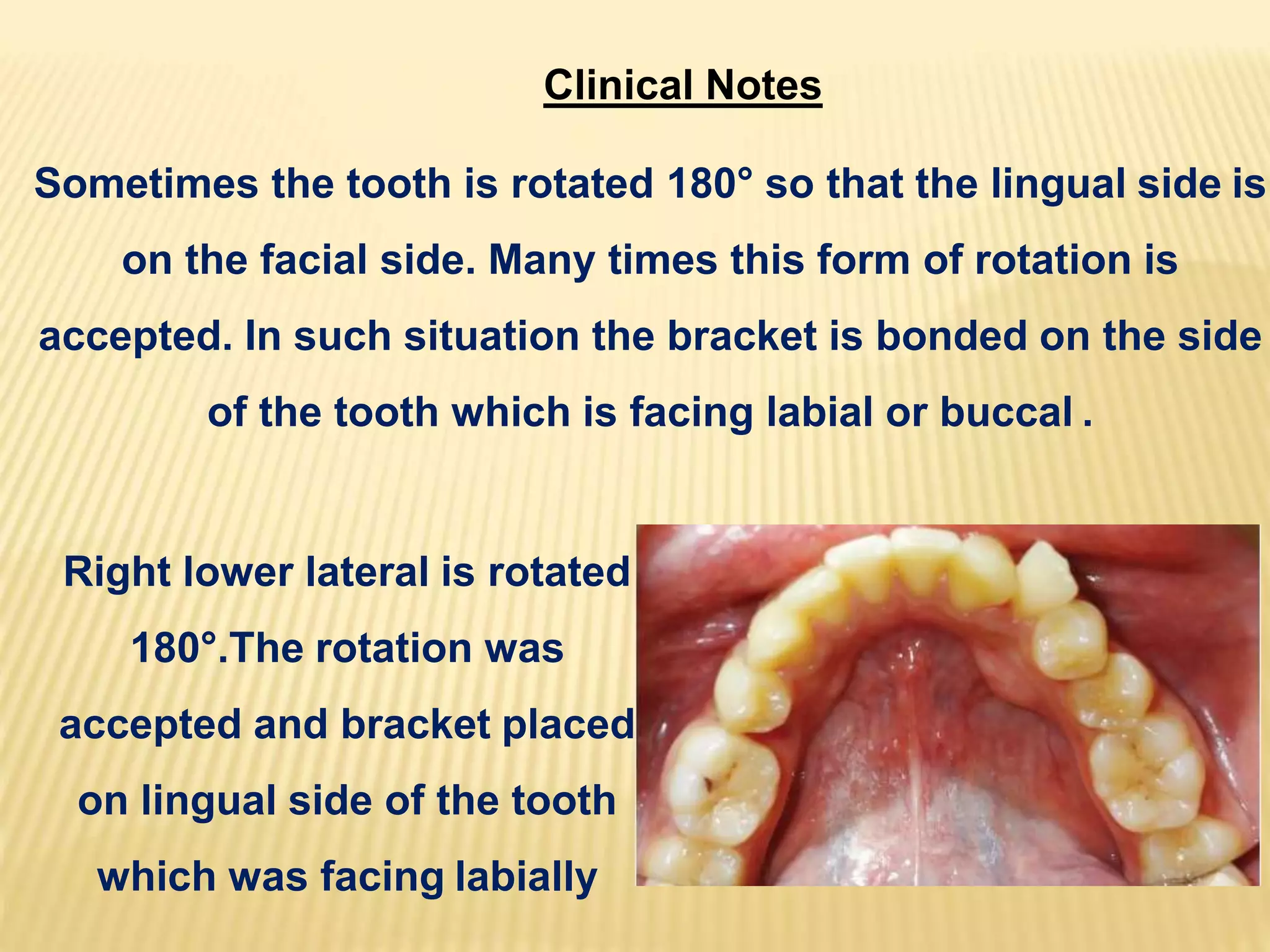 BRACKET PLACEMENT IN ORTHODONTIC BONDING | PPTX