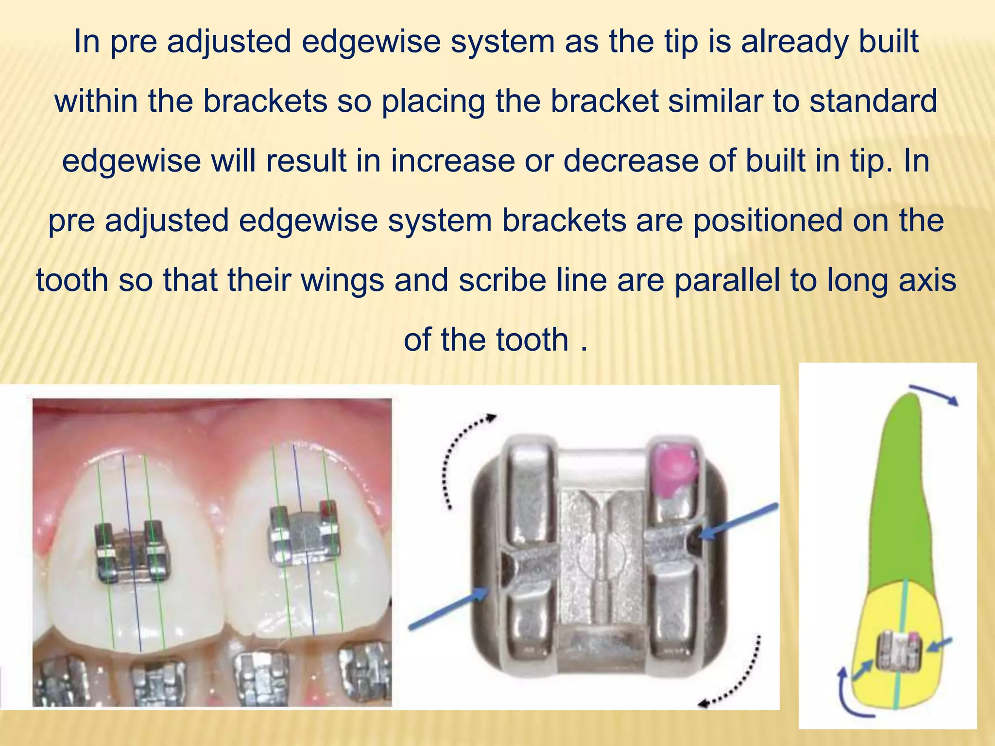 BRACKET PLACEMENT IN ORTHODONTIC BONDING | PPTX