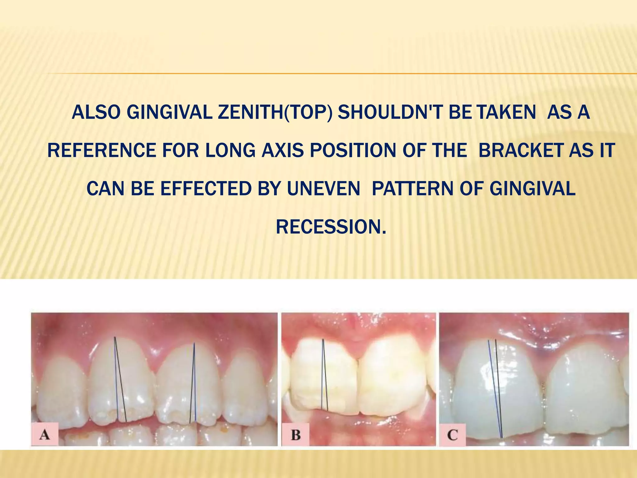 BRACKET PLACEMENT IN ORTHODONTIC BONDING | PPTX