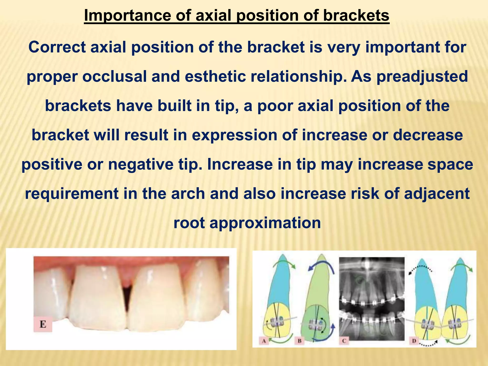 BRACKET PLACEMENT IN ORTHODONTIC BONDING | PPTX
