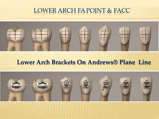 BRACKET PLACEMENT IN ORTHODONTIC BONDING | PPTX
