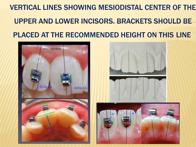 BRACKET PLACEMENT IN ORTHODONTIC BONDING | PPTX