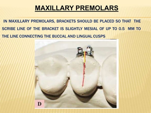 BRACKET PLACEMENT IN ORTHODONTIC BONDING | PPTX