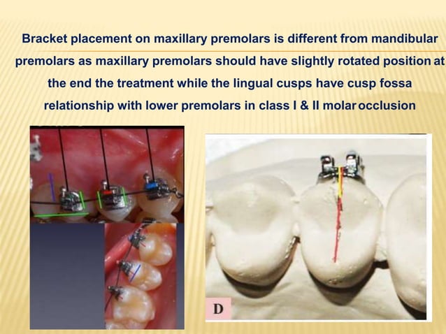 BRACKET PLACEMENT IN ORTHODONTIC BONDING | PPTX