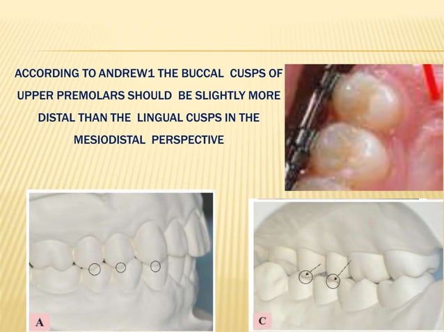 BRACKET PLACEMENT IN ORTHODONTIC BONDING | PPTX