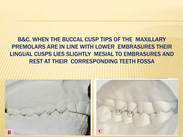 BRACKET PLACEMENT IN ORTHODONTIC BONDING | PPTX