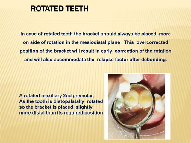 BRACKET PLACEMENT IN ORTHODONTIC BONDING | PPTX