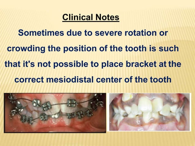 BRACKET PLACEMENT IN ORTHODONTIC BONDING | PPTX
