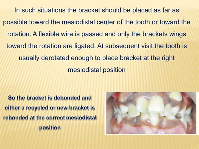 BRACKET PLACEMENT IN ORTHODONTIC BONDING | PPTX