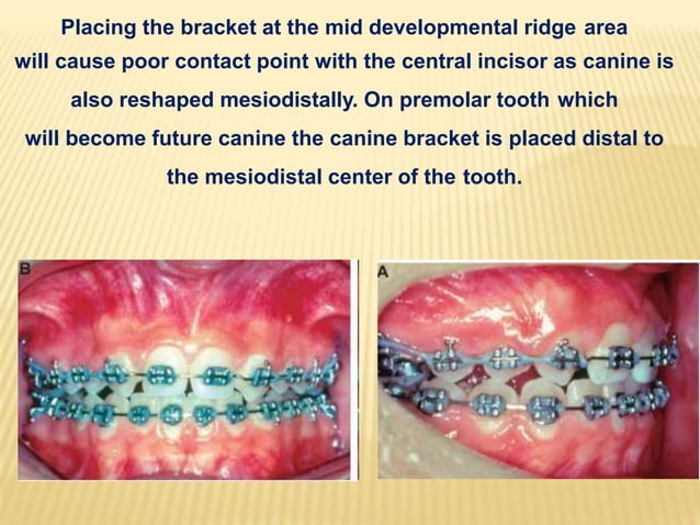 BRACKET PLACEMENT IN ORTHODONTIC BONDING | PPTX