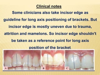 BRACKET PLACEMENT IN ORTHODONTIC BONDING | PPTX