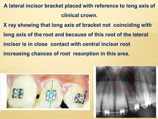 BRACKET PLACEMENT IN ORTHODONTIC BONDING | PPT
