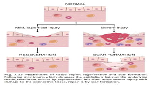 5. chronic inflammation and repair | PPTX