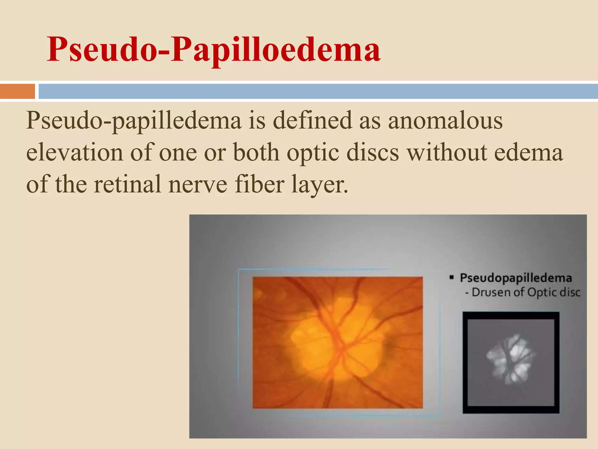 5. papilloedema | PPTX