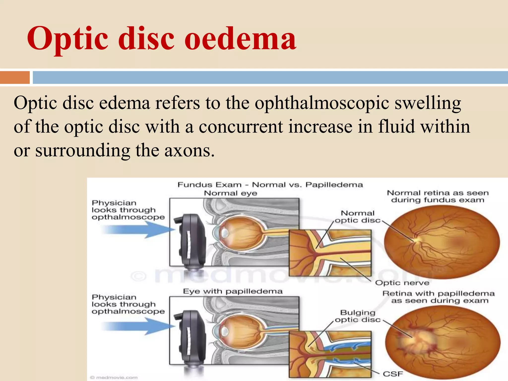 5. papilloedema | PPTX