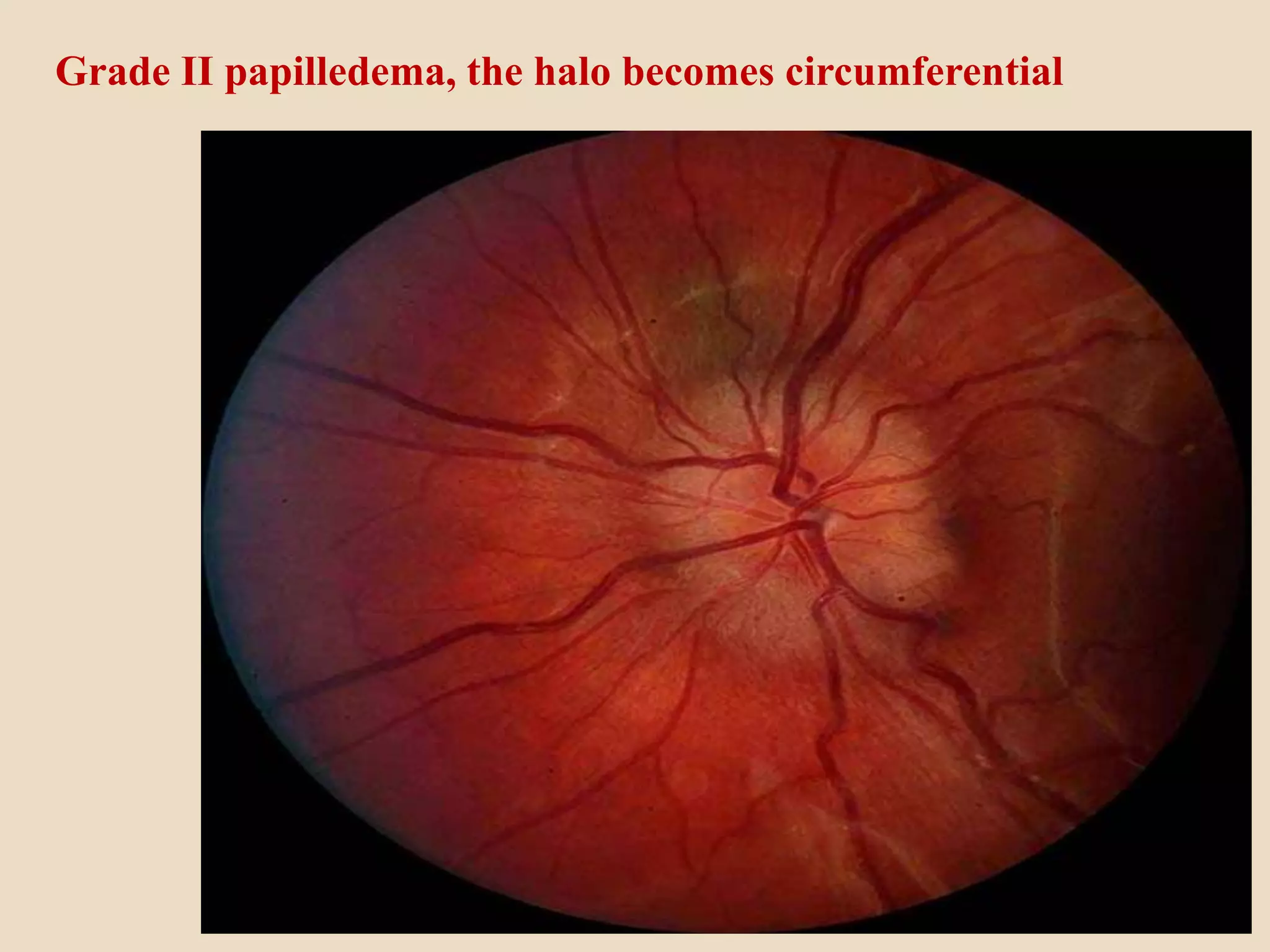 5. papilloedema | PPTX