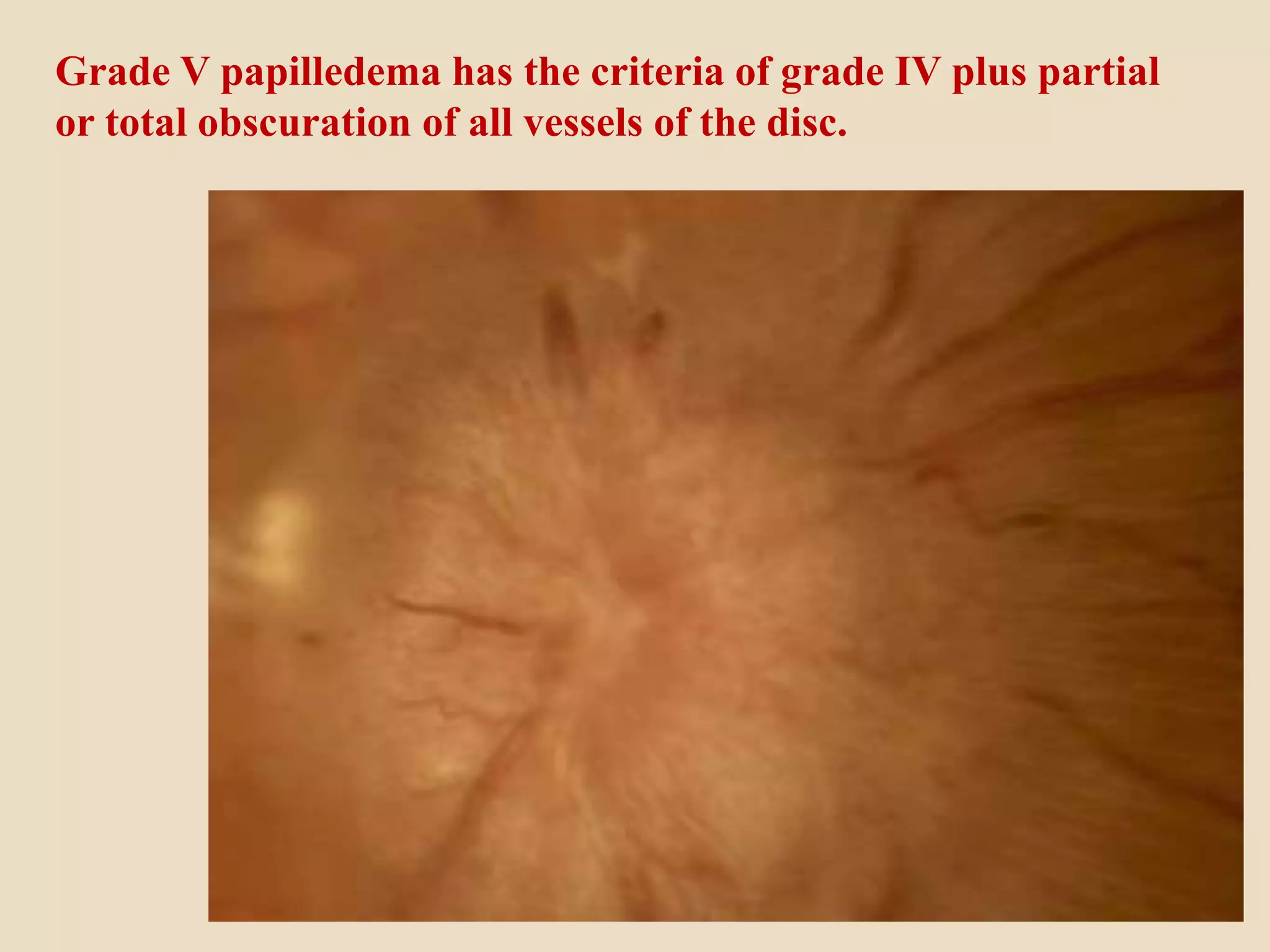 5. papilloedema | PPTX