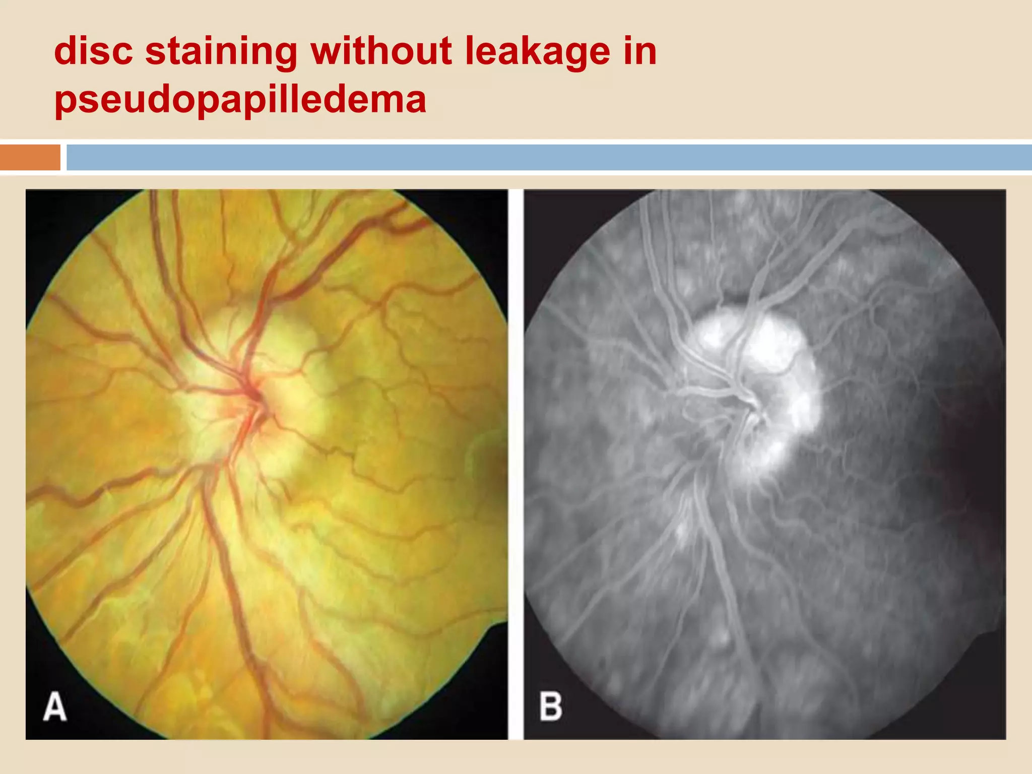 5. papilloedema | PPTX