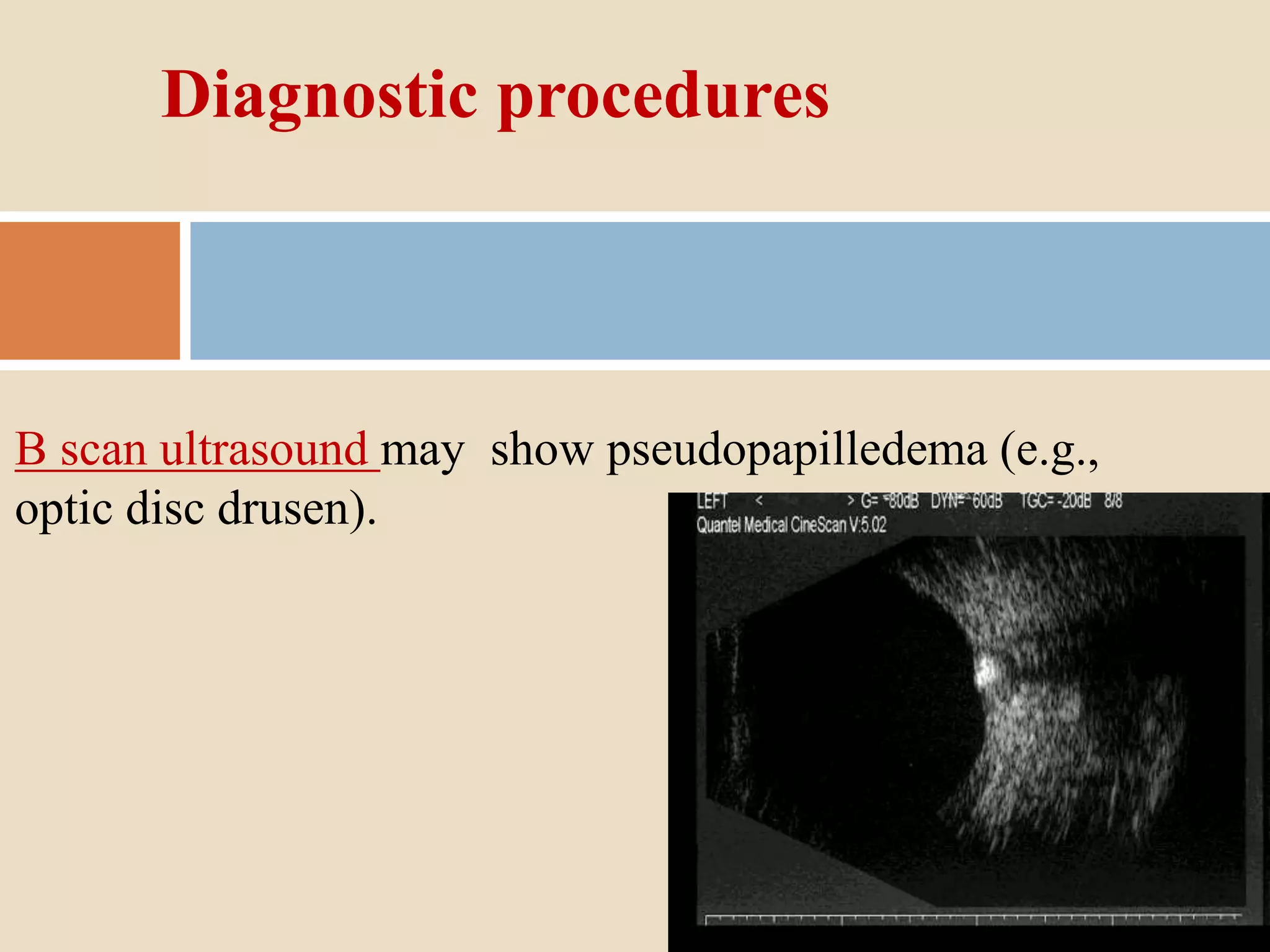 5. papilloedema | PPTX