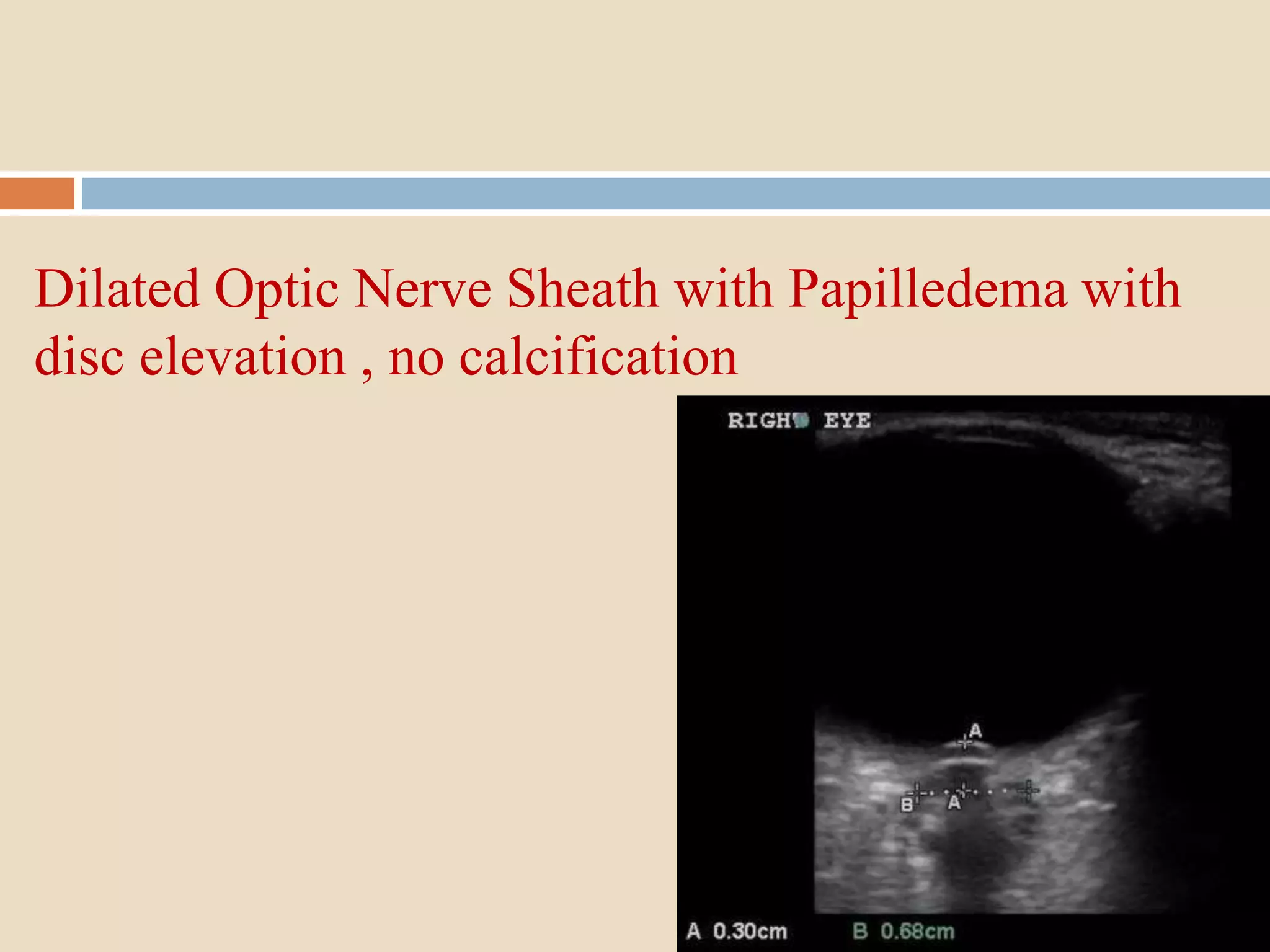 5. papilloedema | PPTX