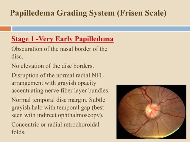 5. papilloedema | PPTX