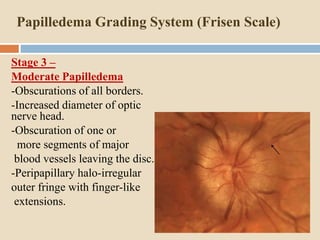 Papilledema Grading